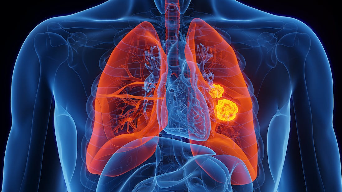 Lung Cancer: Causes, Symptoms, and Treatment Options Explained | by ...