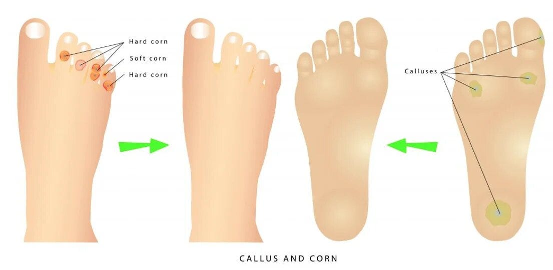 Plantar Warts: Defeating the Unwanted Guests on Your Feet with Best ...