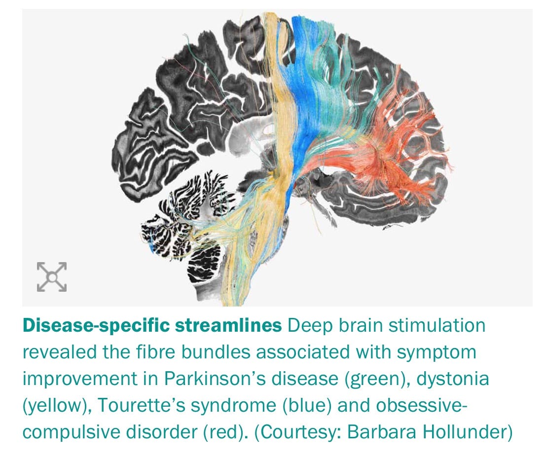 An international research team has used deep brain stimulation (DBS) to ...