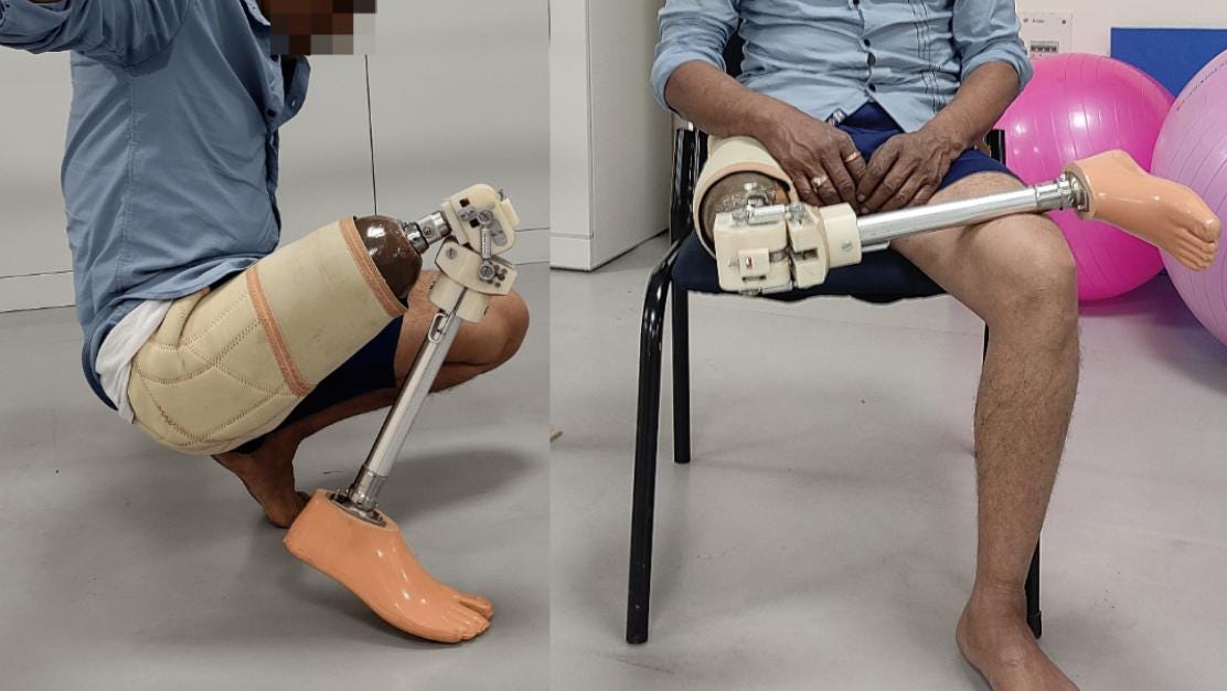 Get Affordable Prosthetic Limbs from Artalive | by Sofia lim | Medium