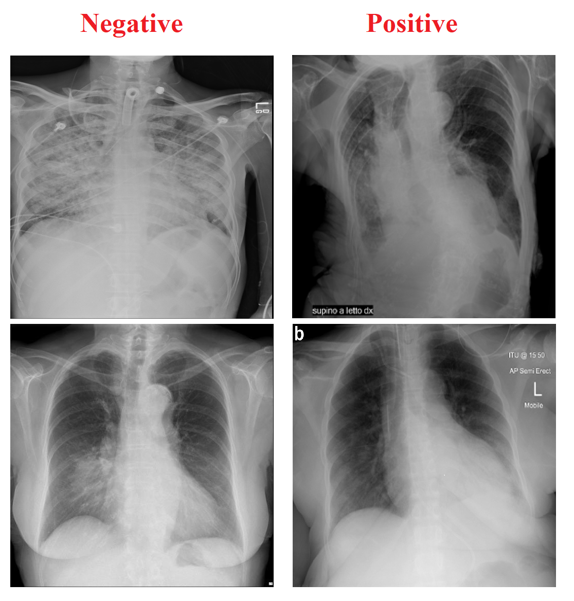 High-Accuracy Covid 19 Prediction from Chest X-Ray Images using Pre ...