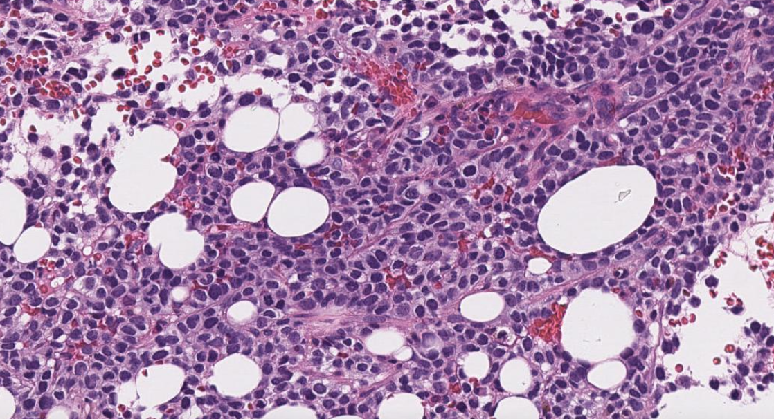 Rhabdomyosarcoma Involving Bone Marrow - Siba El Hussein, MD - Medium