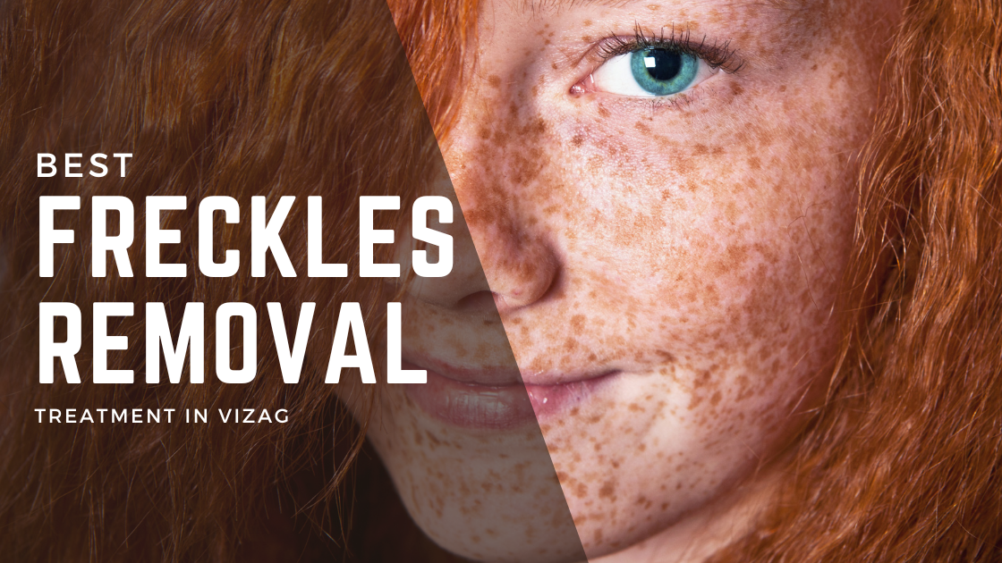 Say Goodbye to Freckles: Top Freckle Removal Treatments at Swarna Cosmo ...