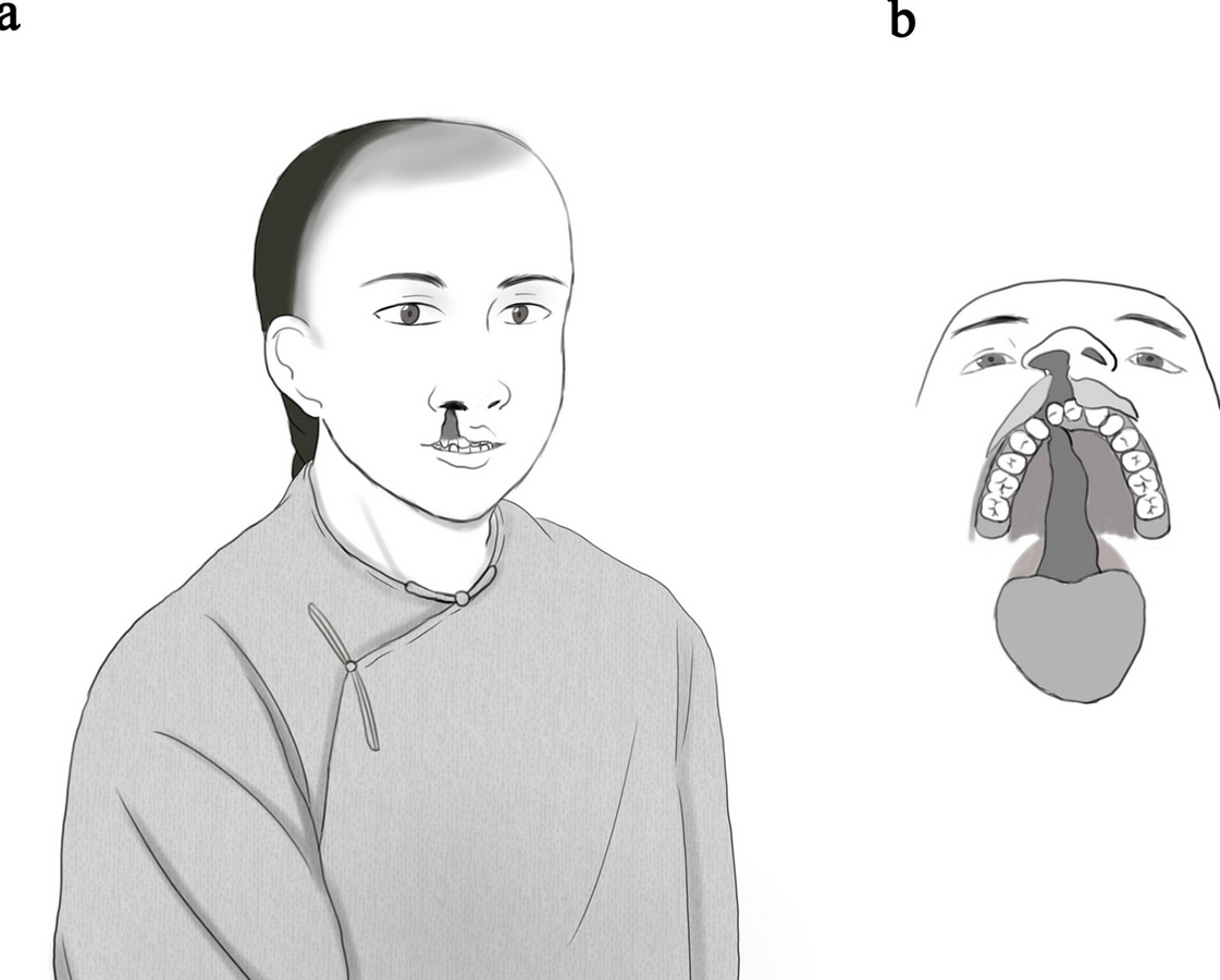 Born Different: What Happened to the First Person With a Cleft Lip Ever ...
