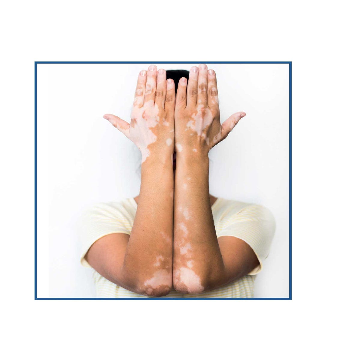 A Closer Look At Vitiligo Common Indicators And Symptoms By Kaya Kalp Global Medium