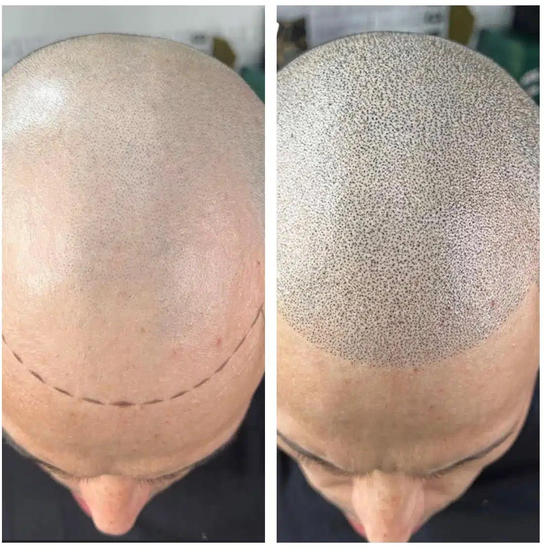 HOW CAN SMP HELP IN HAIRLINE RESTORATION? | by Natural Scalp | Medium