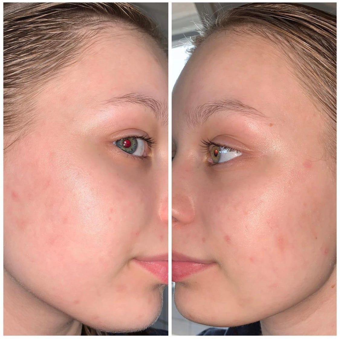 How I went from an acne-filled face, to almost completely clear skin ...