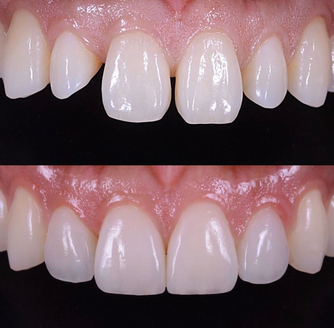 ‪Veneer transformation!‬. ‪Monterey Hills Dental‬ | by Poria Edalat | Medium