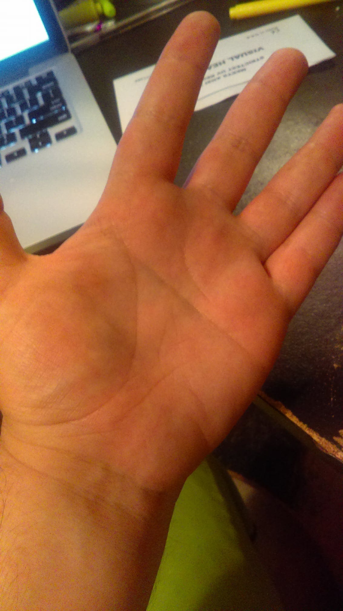 The ‘Simian Crease’. Palmistry is an amusing pseudoscience… | by ...