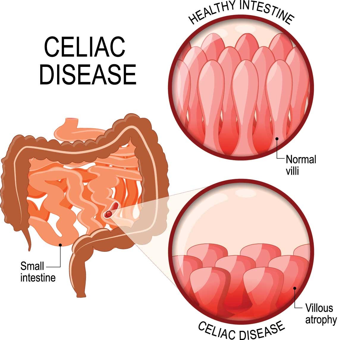 What are the common symptoms of celiac disease? | by Globus Hospital ...