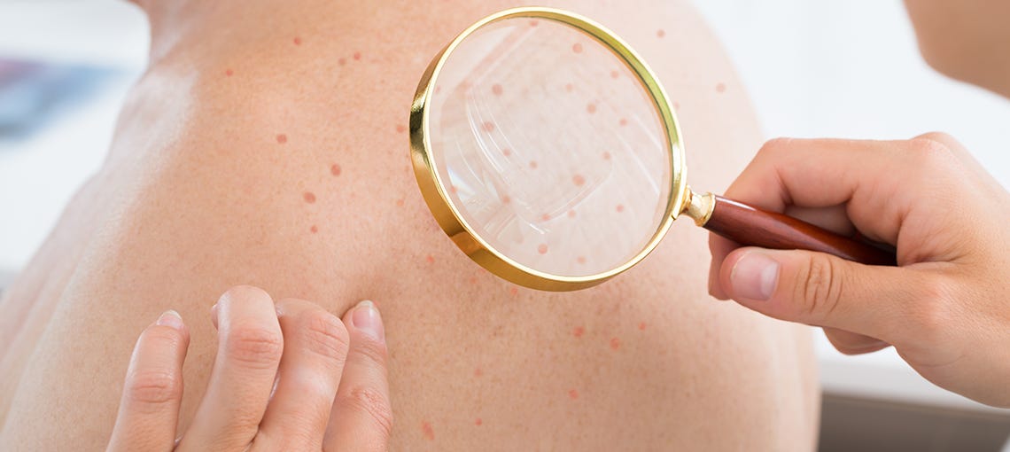Signs and Symptoms of Melanoma Skin Cancer | by Sai Fast Service | Medium