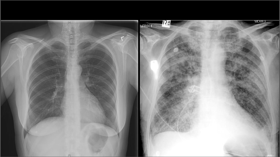 Image Classification: Using AI to Detect Pneumonia | by Samuel Mohebban ...