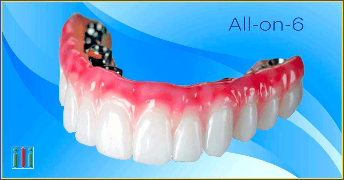ALL-ON-6 TOOTH REPLACEMENT — ORAL REHABILITATION IN 3 WEEKS | by Jim ...