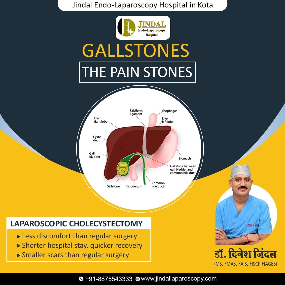 Gallbladder Removal Surgery (Cholecystectomy) by Laparoscopic | by ...