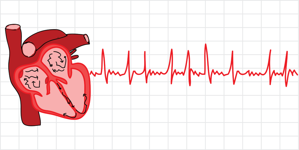 Understanding AFib: A heart dancing without rhythm | by Stanford ...