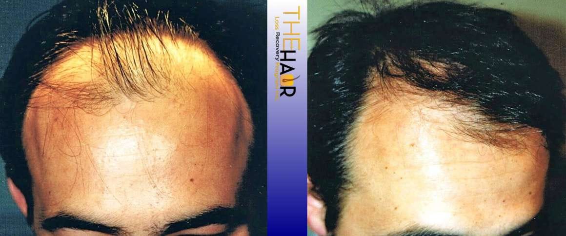 Hair Loss Solutions for Everyone. 🤝 | by The Hair Loss Recovery Program ...