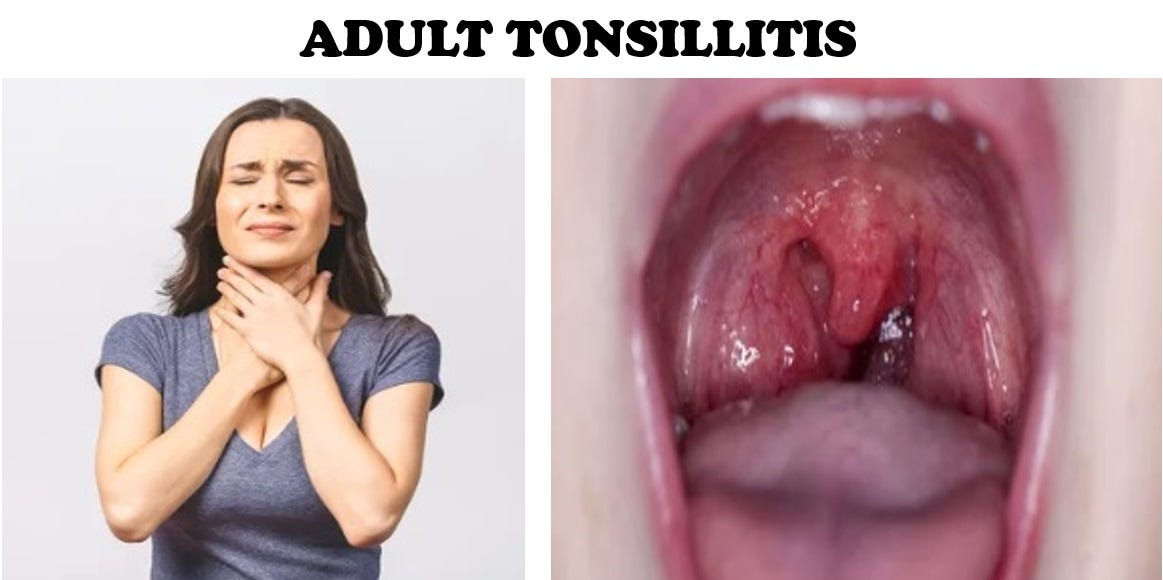 Bacterial Tonsillitis