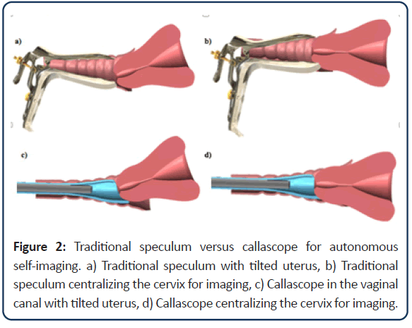 Tilted Cervix Self Examination