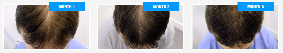 My Journey Revealed: How to Overcome Hair Loss with Profolan | by best ...