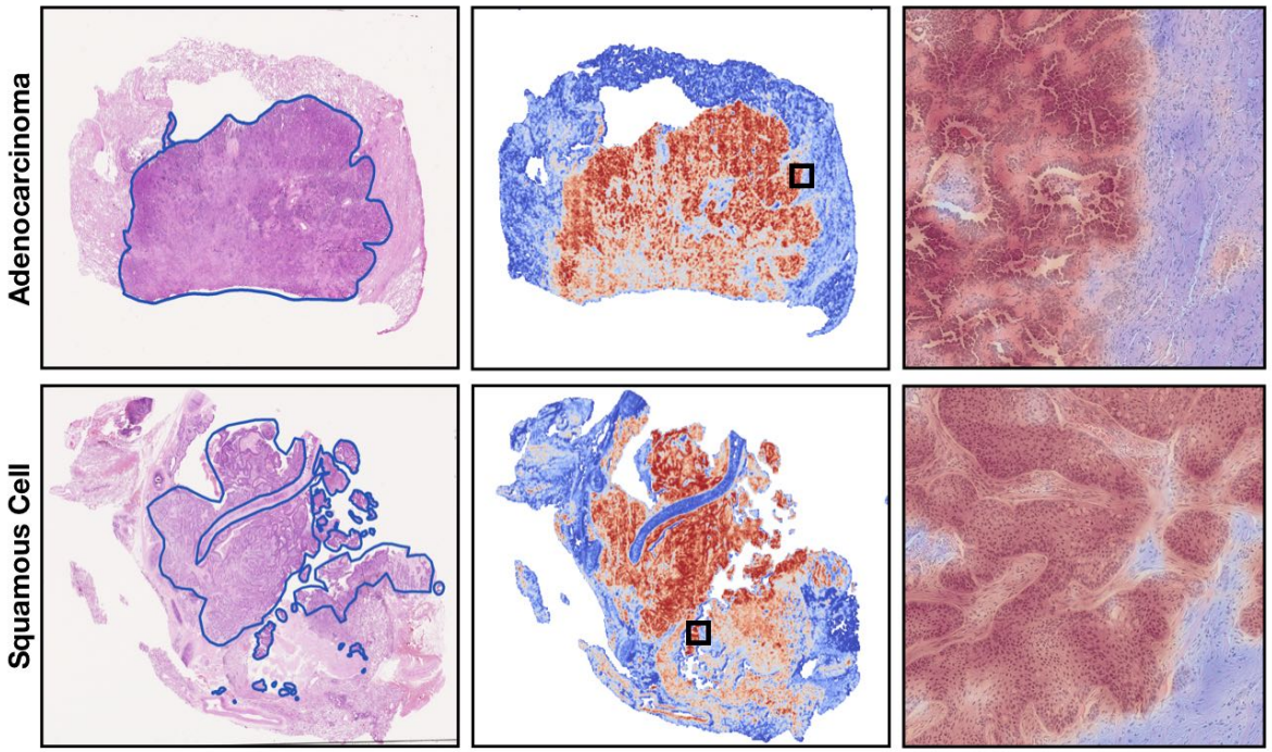 From Patches to Slides: How to Train Deep Learning Models on Gigapixel Images With Weak ...