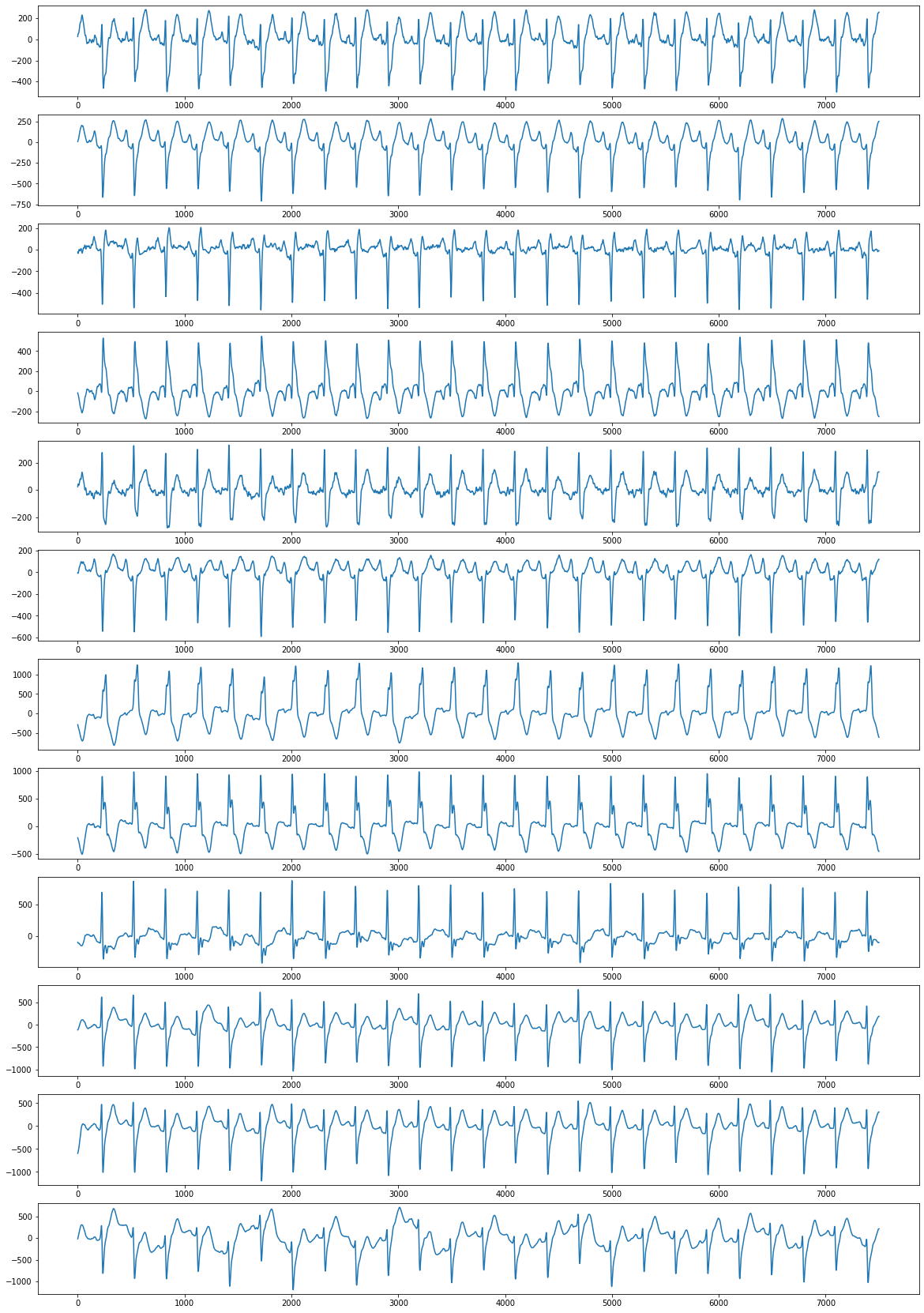 Physionet ECG challenge. Introduction | by Oleksandr Syzonov | Medium
