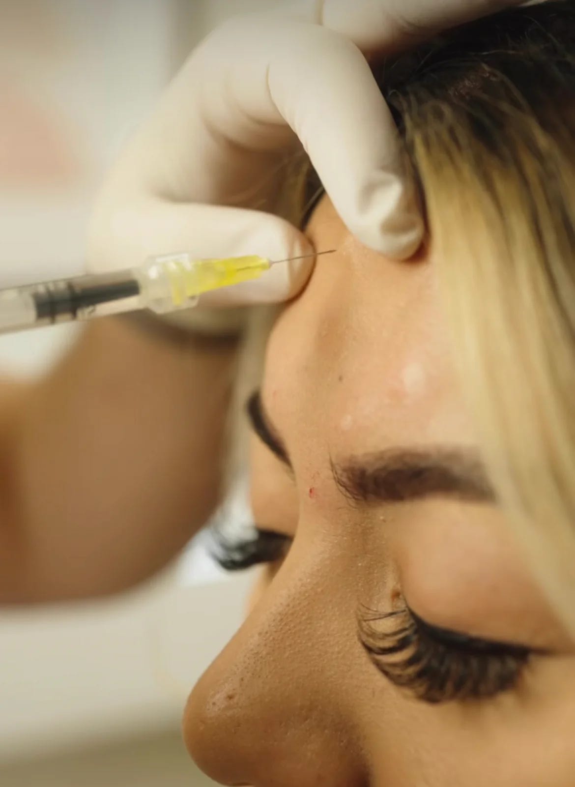 Transform Your Look: Discover the Best Botox in Los Angeles! | by ...