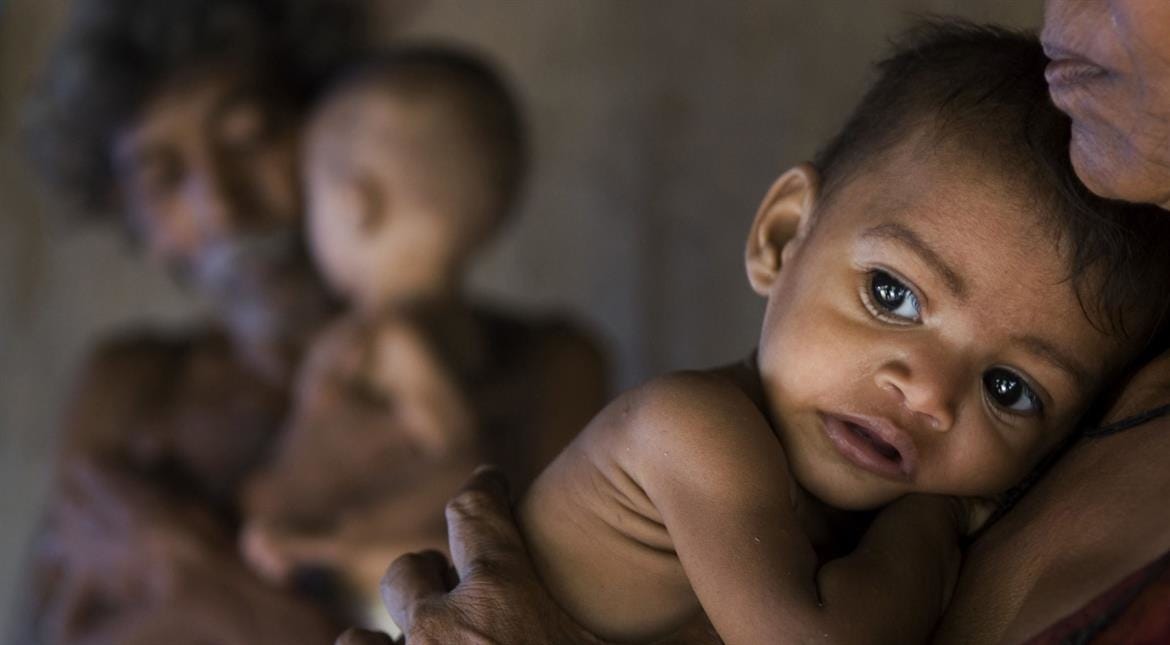 PEM. Protein-Energy Malnutrition (PEM) is a… | by Shari Ajith | Aug ...