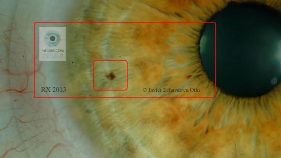Birth of an iridian sign (iris marking). | by infoiris | Medium