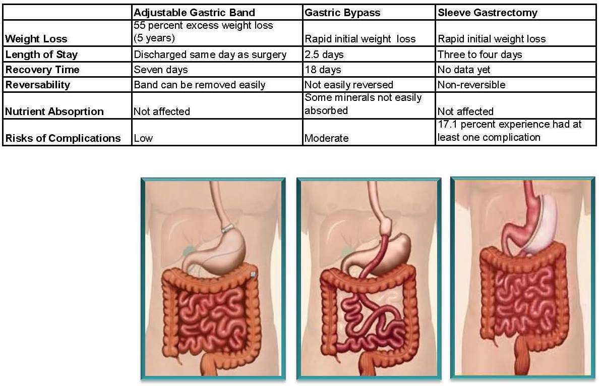 Weight reduction Medical procedure Choices | by Halimi Djamel | Apr, 2024 | Medium