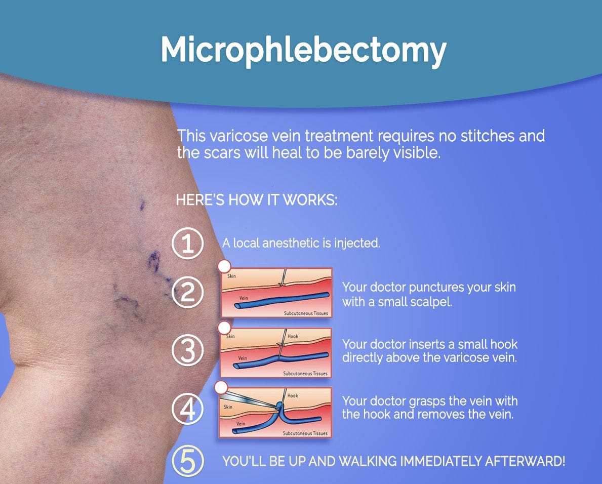 Ambulatory Microphlebectomy. Ambulatory microphlebectomy is a… | by ...
