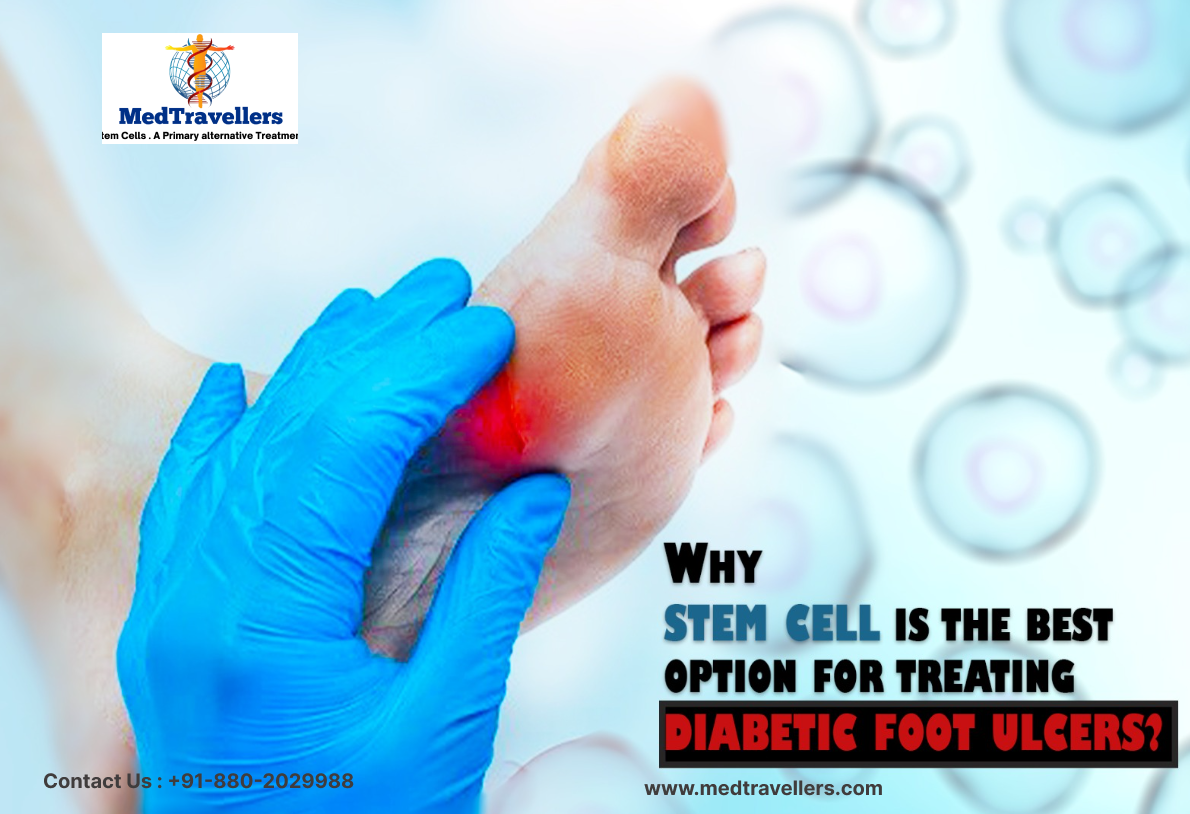 Why Stem Cells are the Best Option for Treating Diabetic Foot Ulcers ...
