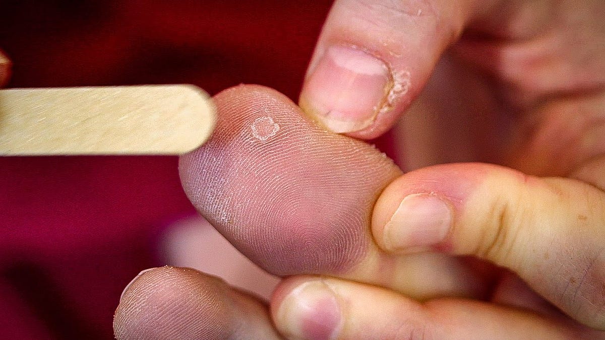 How to Remove Warts Quickly. If you’ve been wondering how to remove ...
