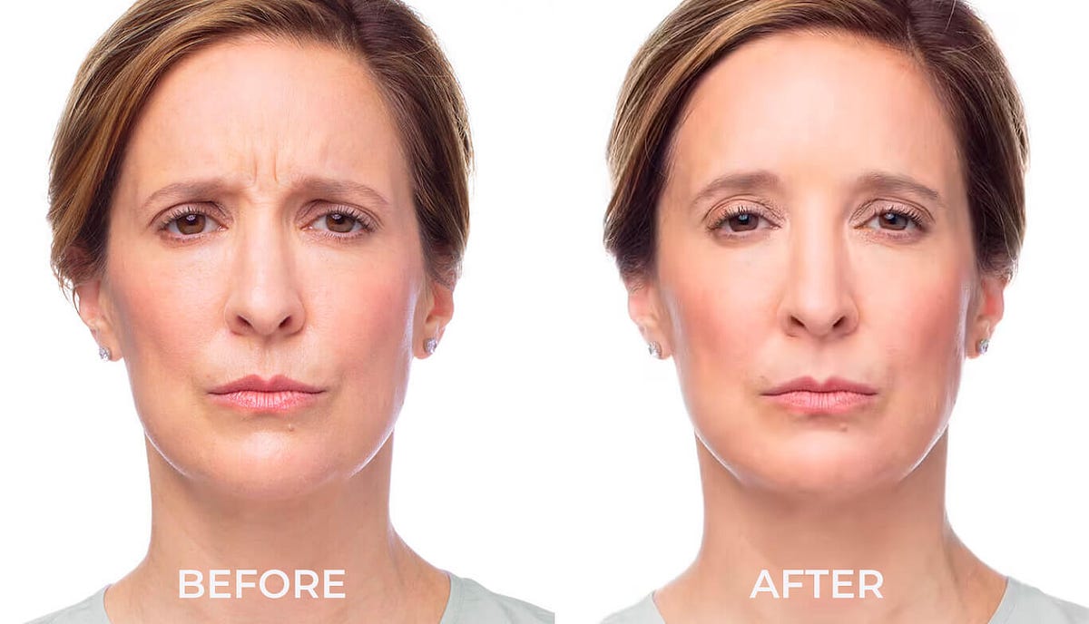 Brow Lift with Neurotoxins Procedures: A Non-Surgical Approach to ...