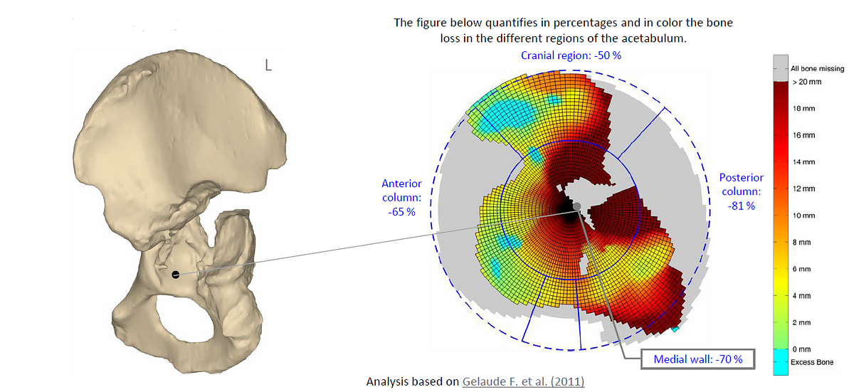 From Motor Crash to Walking after an Acetabular Reconstruction with 3D ...