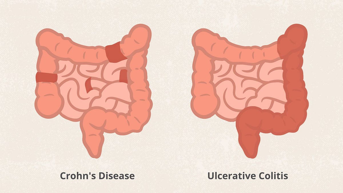 Understanding of Crohn’s Disease: Symptoms and Treatment | by Harshit ...