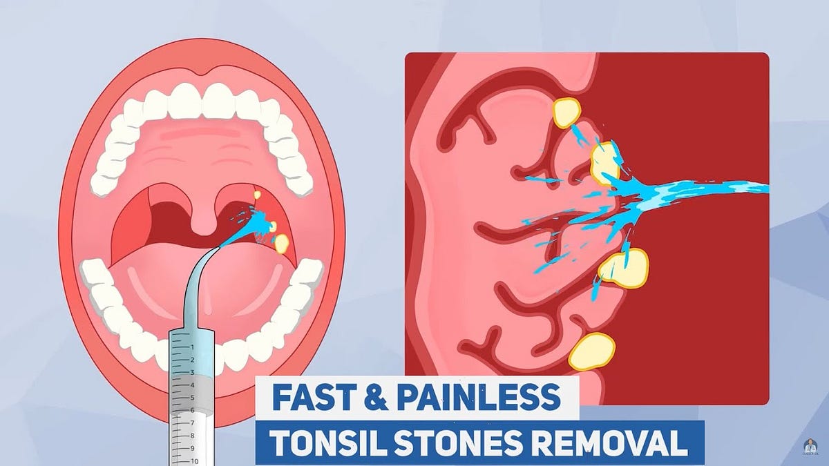 tonsil stone removal tool | by Toni Morrison | Jul, 2024 | Medium