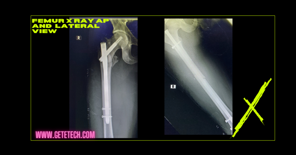 Femur Anatomy Xray