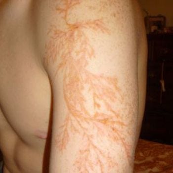 The most terrifying part about getting struck by lightning is what ...