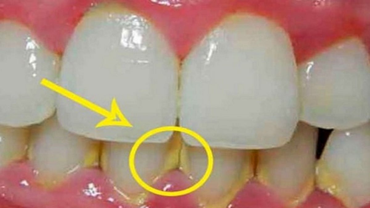 Dangers of plaque on gums. What exactly plaque? Plaque is known as ...