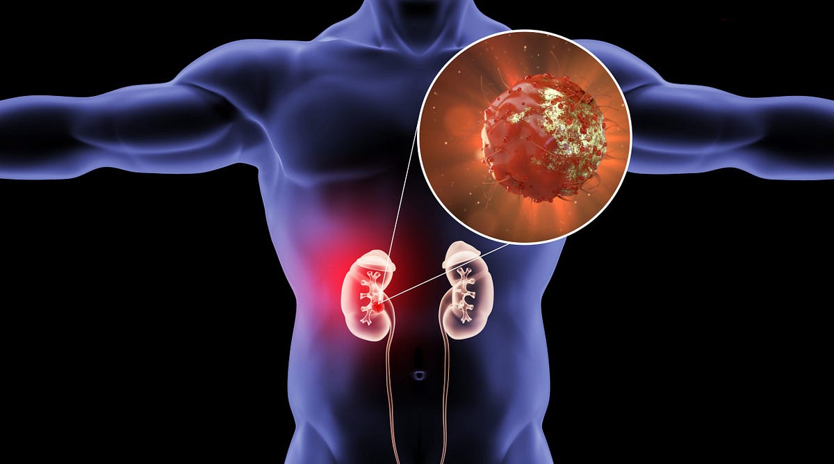 Kidney Disorders And Nephrologist | by Nephrologistinfaridabad | Medium