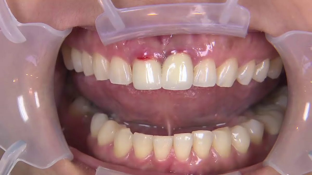 Symptoms Of Ill-fitting Dental Bridge | by Chaneymoisesnapb | Jan, 2024 ...