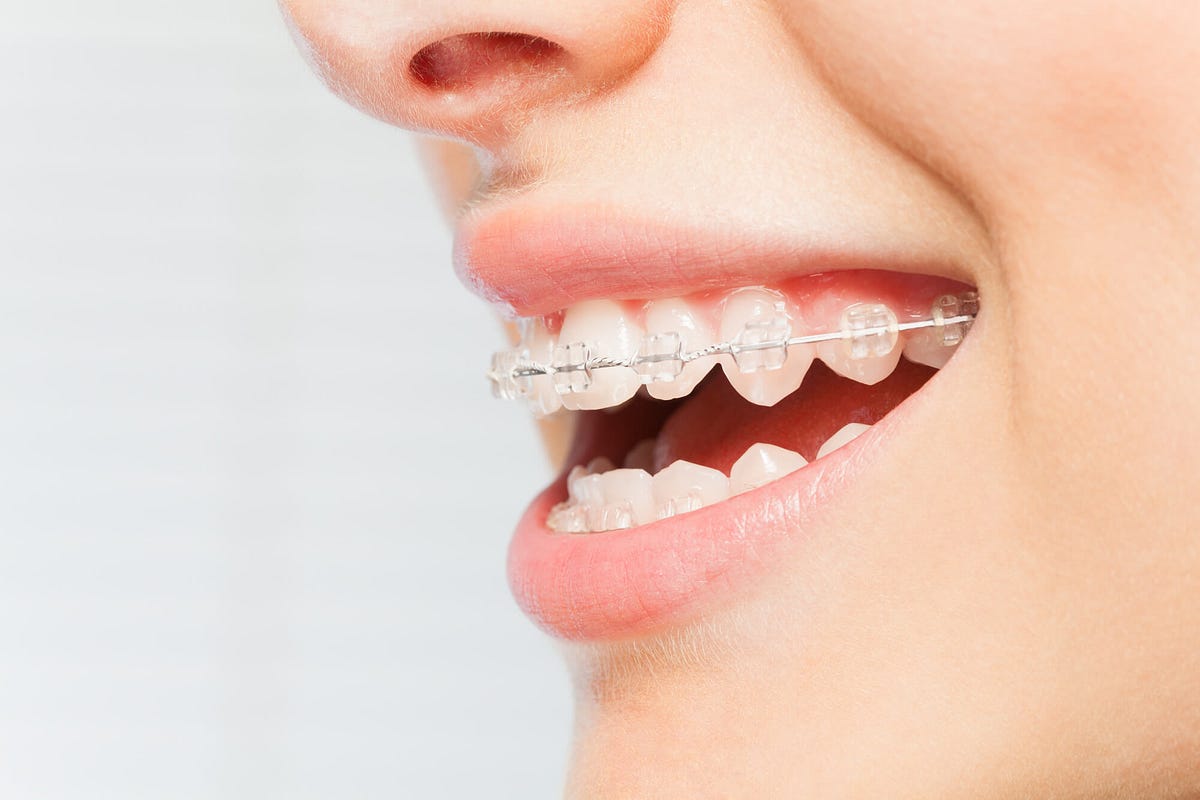 EVERYTHING YOU NEED TO KNOW ABOUT MALOCCLUSION | by Smithamira | Medium