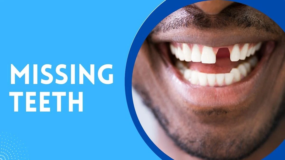 From Missing Teeth to Confident Smiles: Exploring the Power of Dental Implants | by ...