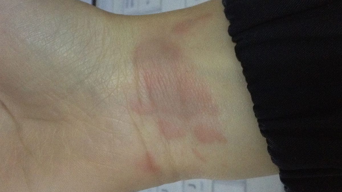 How to use skin burn cream to treat a low-temperature burn accidentally ...