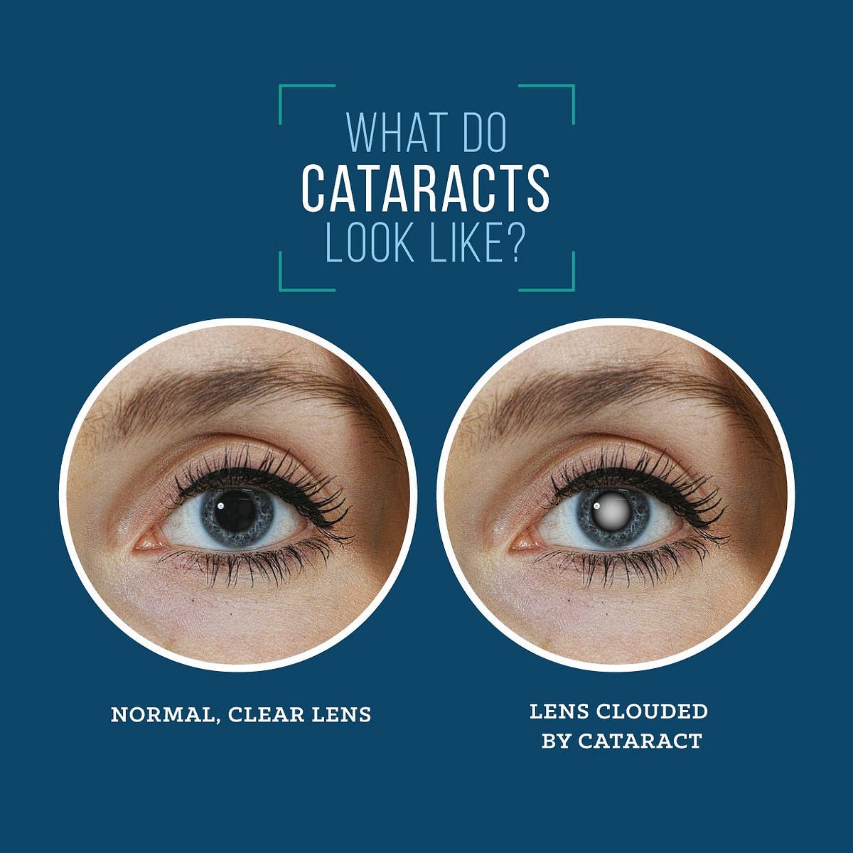 All You Need to Know about Cataracts | by littleflower hospital | Medium