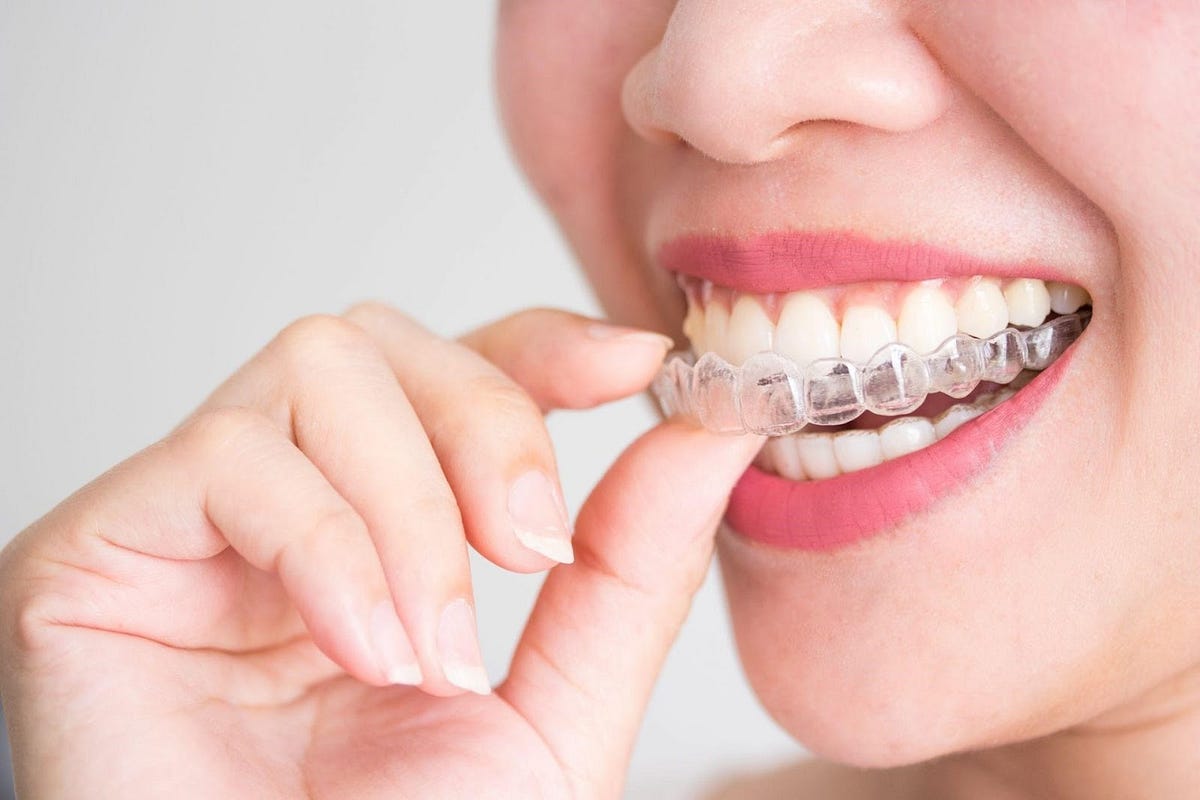 The Science Behind How Invisalign Aligners Work | by Emila Wing | Oct ...
