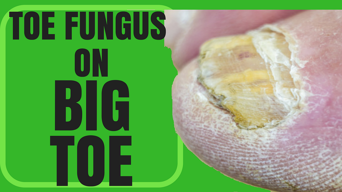 Toenail Fungus on Big Toe | by Great Health Care Products | Medium