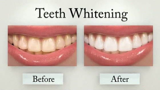 How To Get Rid Of Calcium Deposits On Teeth | by how2world | Medium