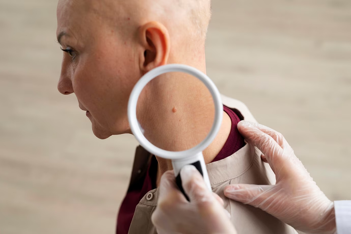 Skin Tags: How to Get Rid of AnnoyingSkin Growths | by Jones Miller ...