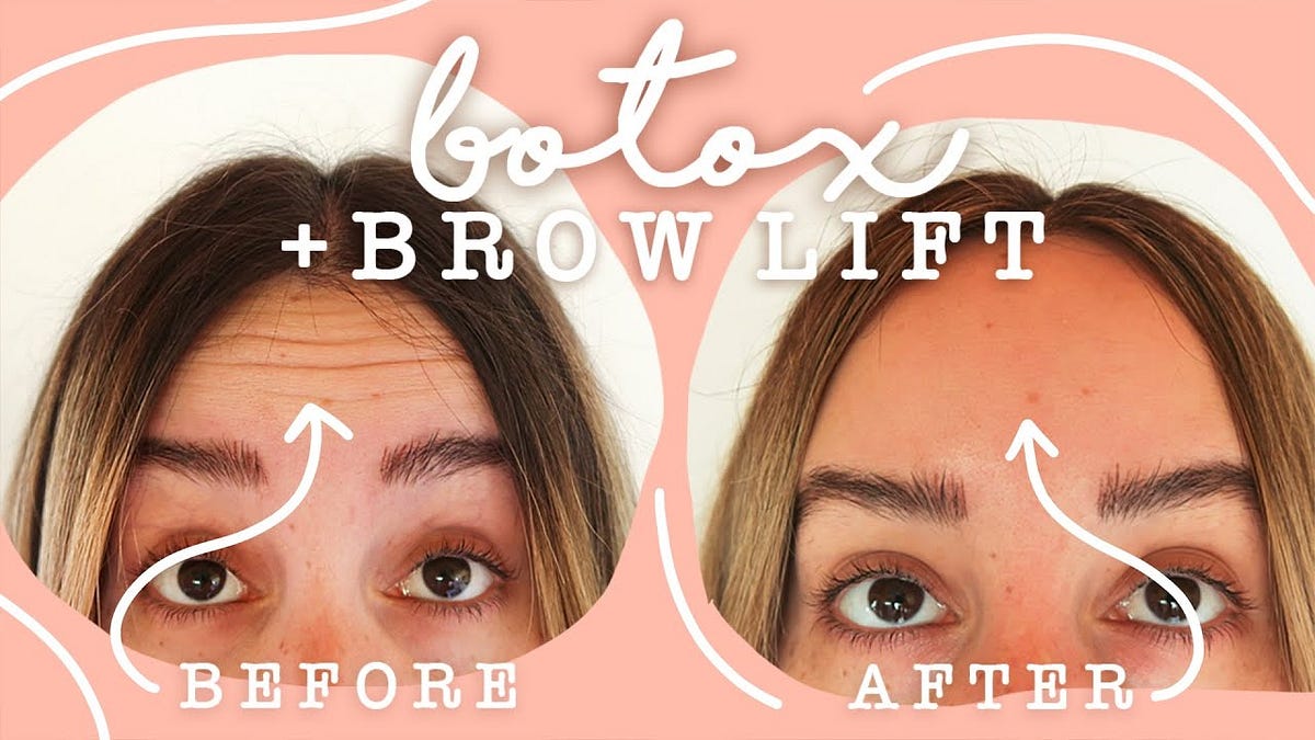 How Much Is a Brow Lift | by 1Girl1Boy | Medium